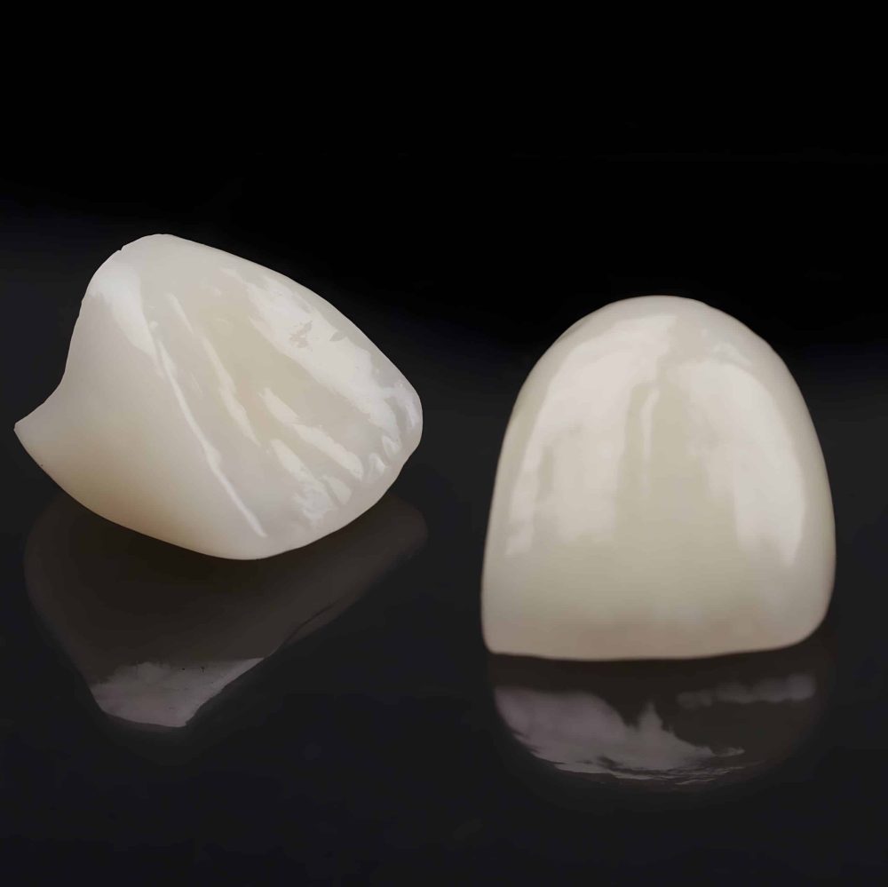 Anterior Crowns in Knoxville | Knoxville Prosthodontics